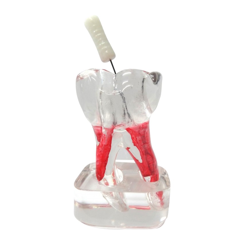 MODELO DENTE 36 DE ENDODONTIA COM RAIZ - ROIC (C/ 01KIT)